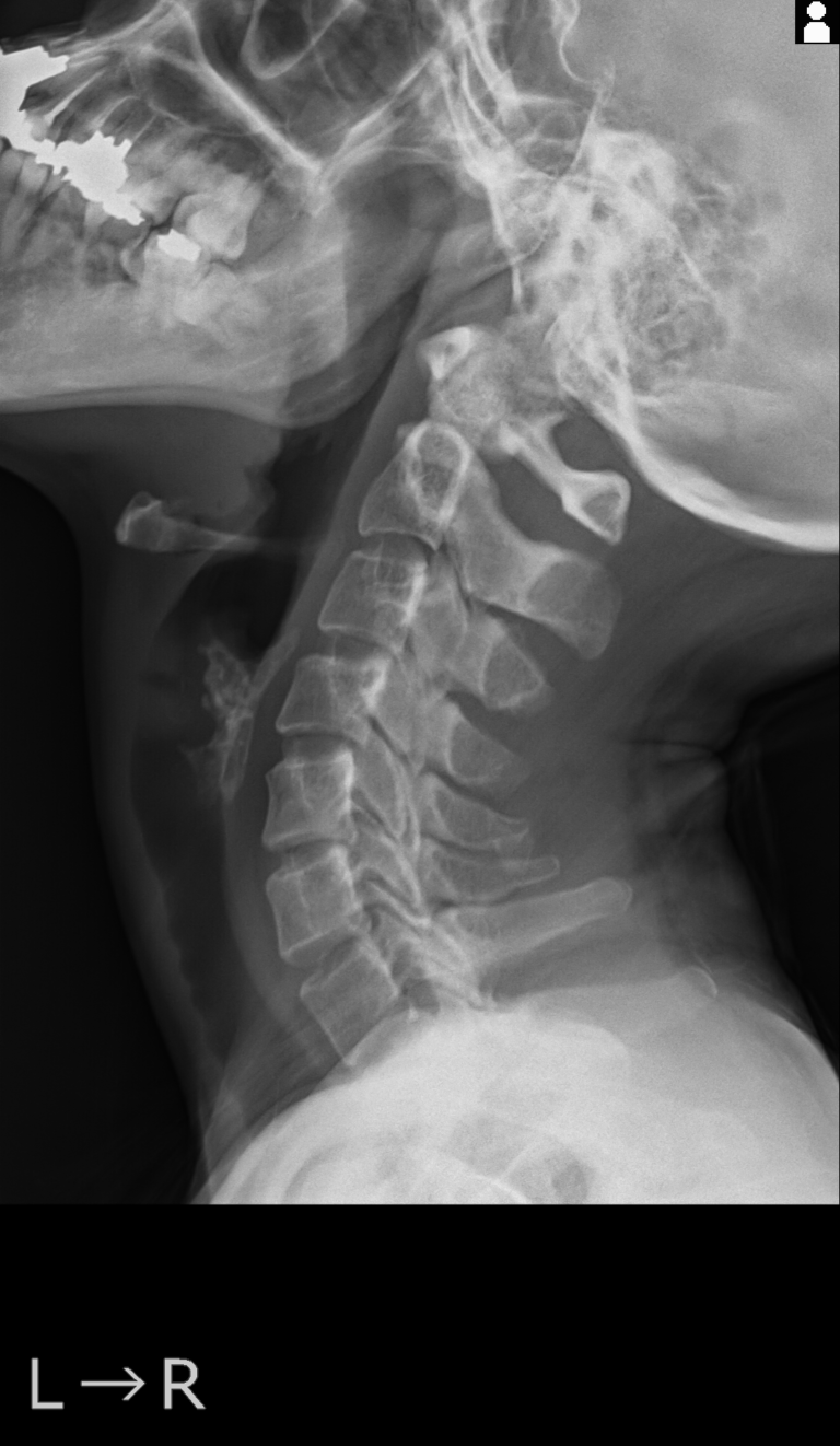 Crowned Dens Syndrome 2 症例 _ Crowned Dens Syndrome 症例 – YMCOWA