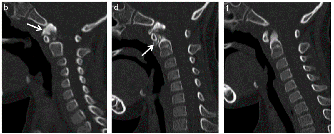 【CT撮らないとわからない】首が固い・回らない！治らない原因は？【Crowned dens syndrome】│佐藤脳神経外科|豊橋|MRI ...